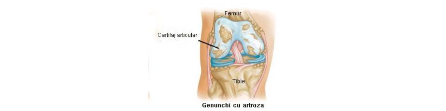 Gonartroza genunchi - Ina Medical Sport