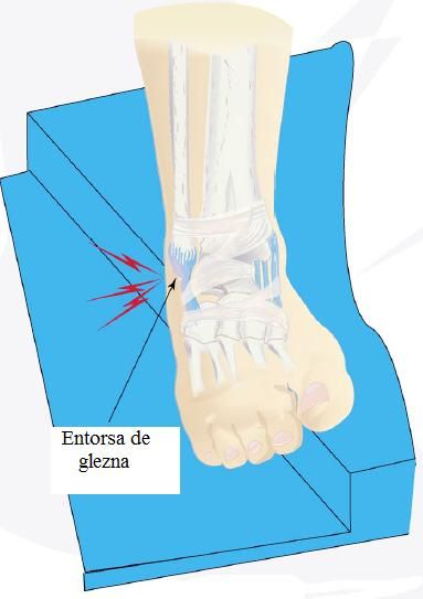 Leziuni , afectiuni ale gleznei si piciorului